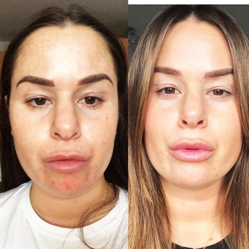 NEOFOUND (PROFOUND) 5x3ml - Účinná biorevitalizácia, omladenie pre ...