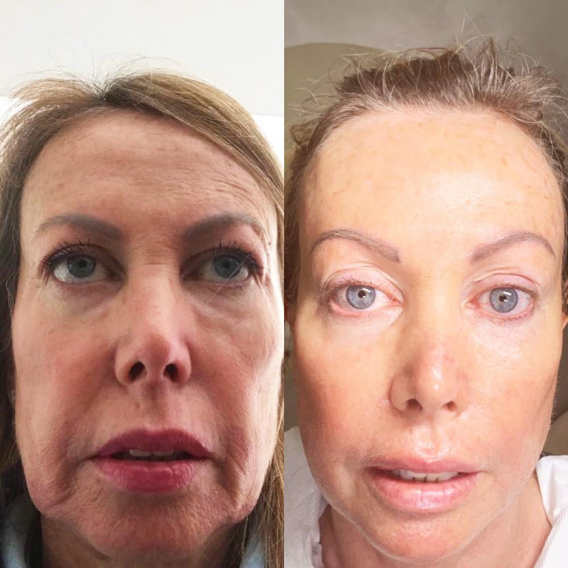 NEOFOUND (PROFOUND) 5x3ml - Účinná biorevitalizácia, omladenie pre ...